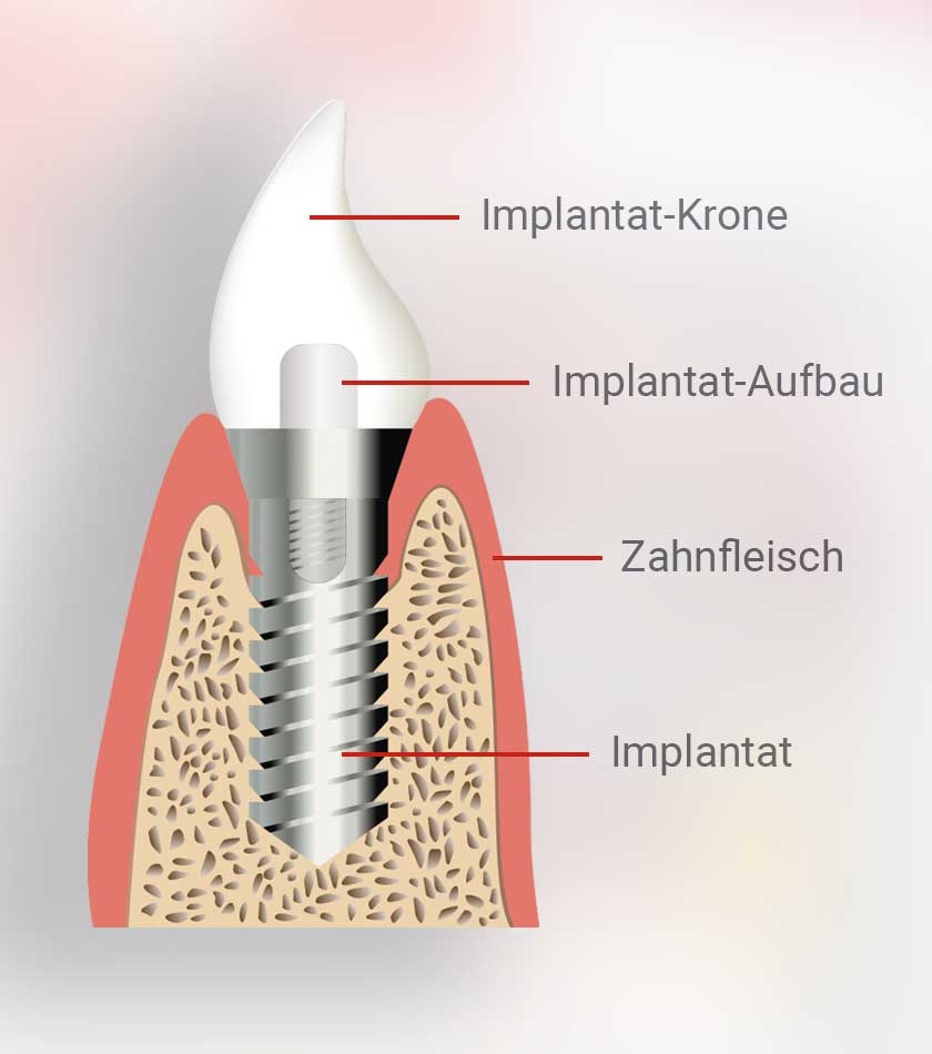 Zahnimplantate – Kosten & Ablauf | MED:SMILE